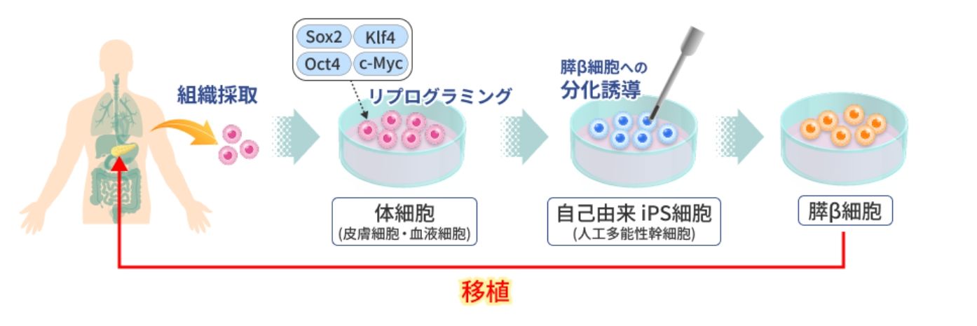 糖尿病再生医療・幹細胞治療なら青山レナセルクリニック | 糖尿病 基礎知識